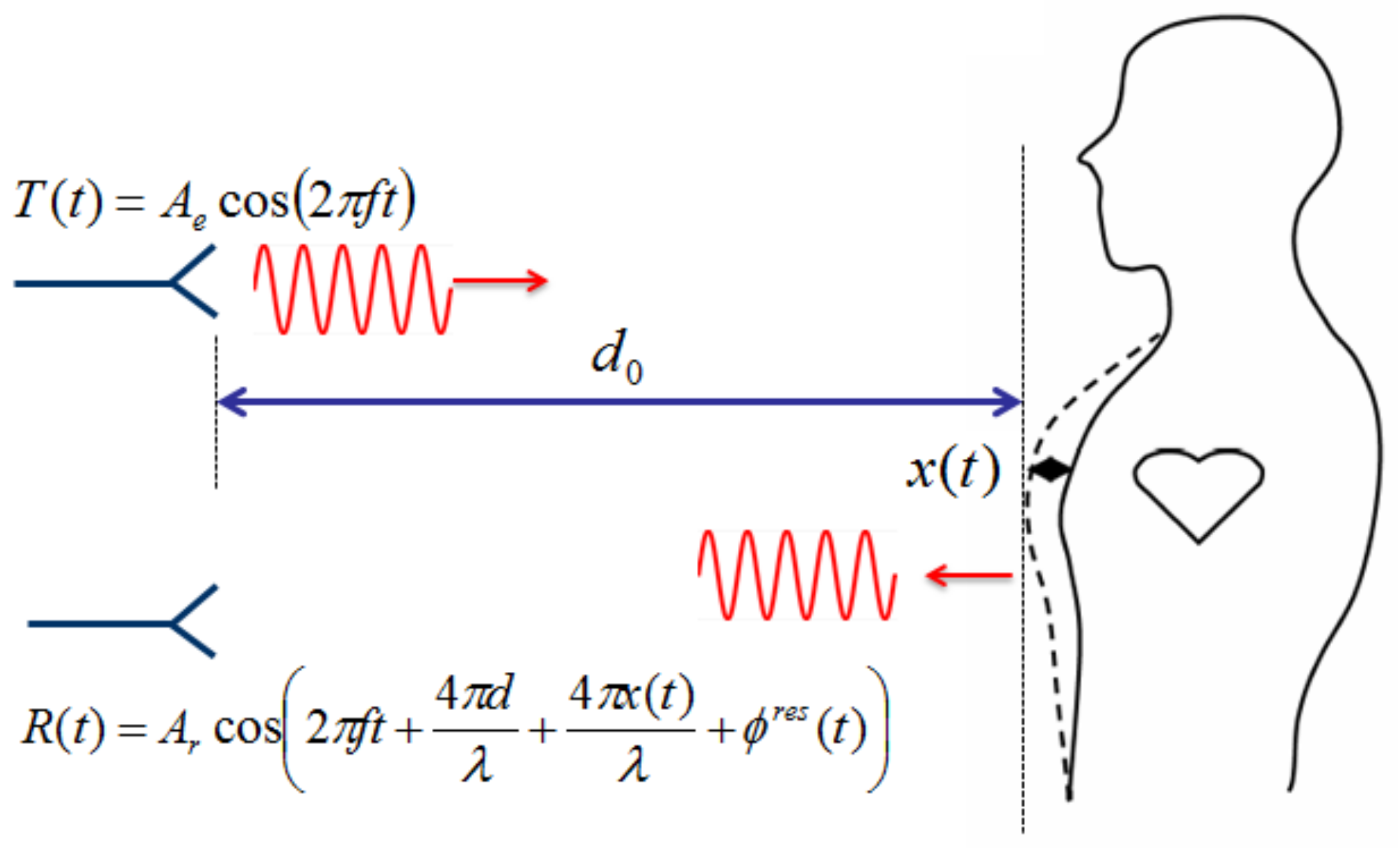 Estimation of Human Body Vital Signs Based on 60 GHz Doppler Radar ...