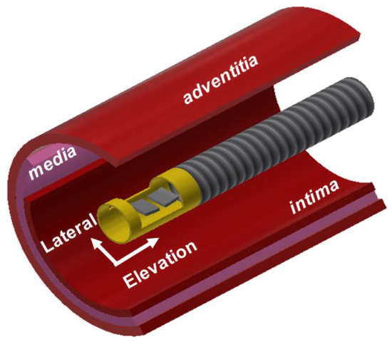A 35 MHz/105 MHz Dual-Element Focused Transducer for Intravascular ...