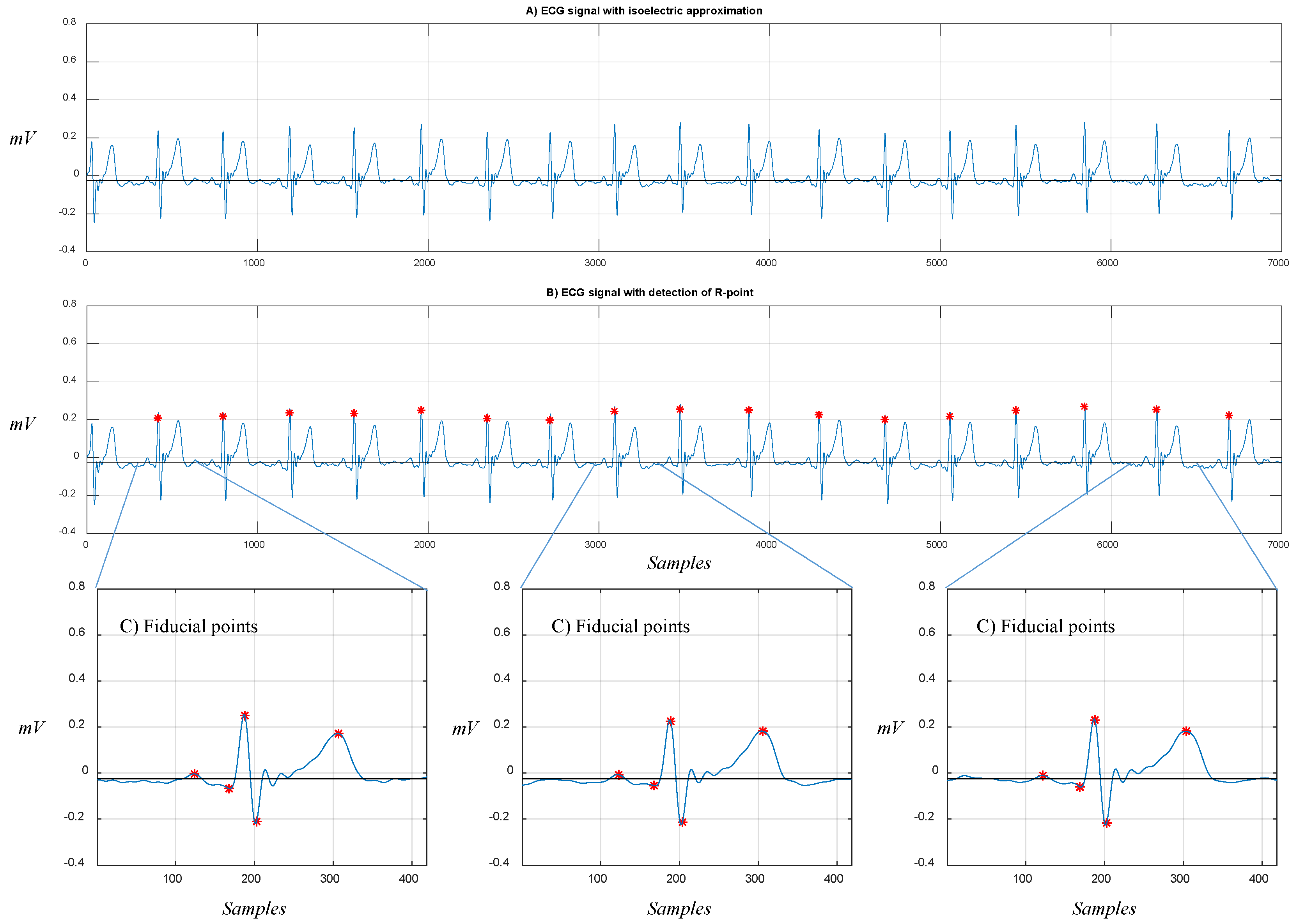 Segmentation of the ECG Signal by Means of a Linear Regression Algorithm