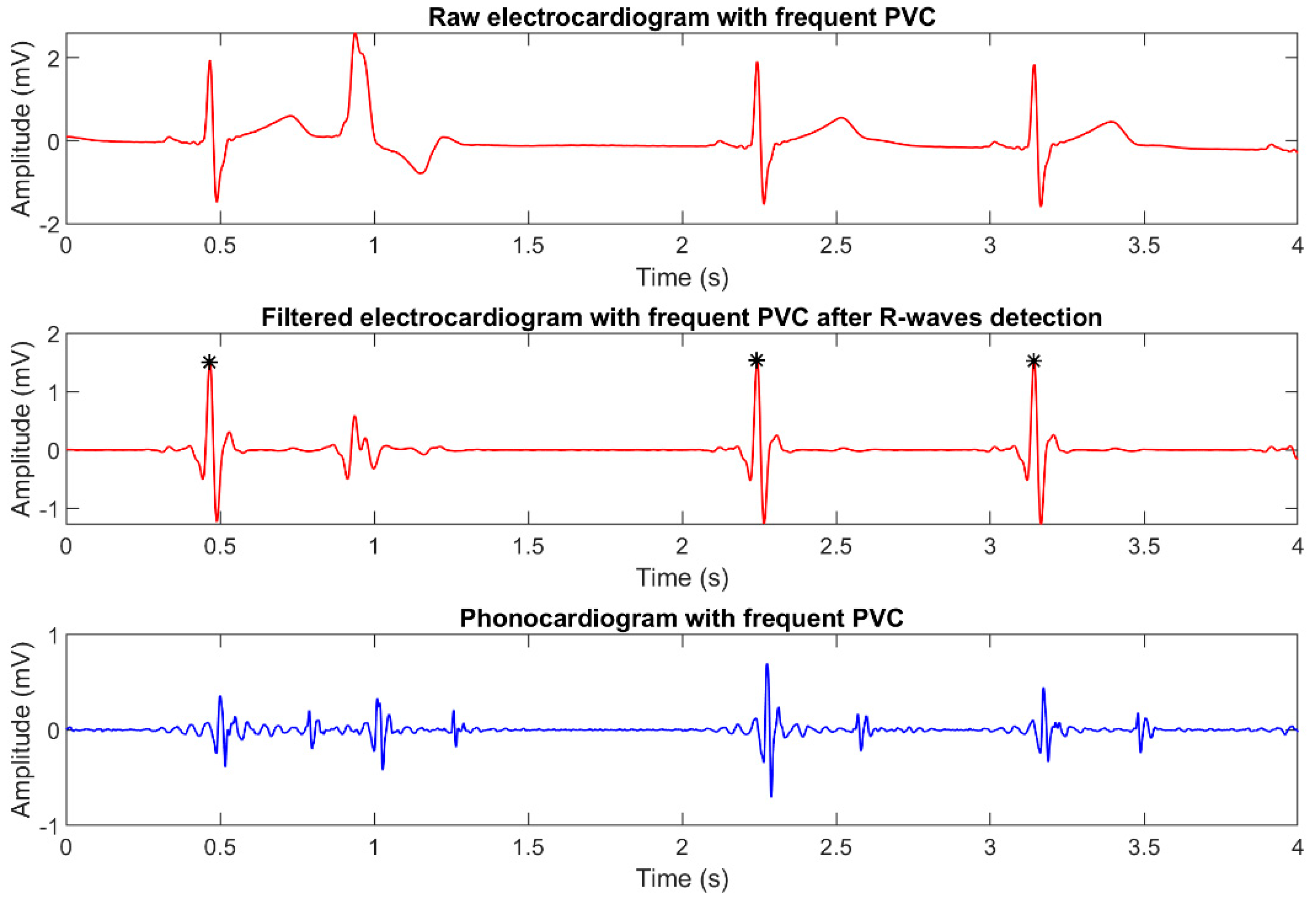 A Novel Method for Measuring the Timing of Heart Sound Components ...