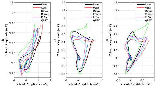 Comparison of Different Electrocardiography with Vectorcardiography ...