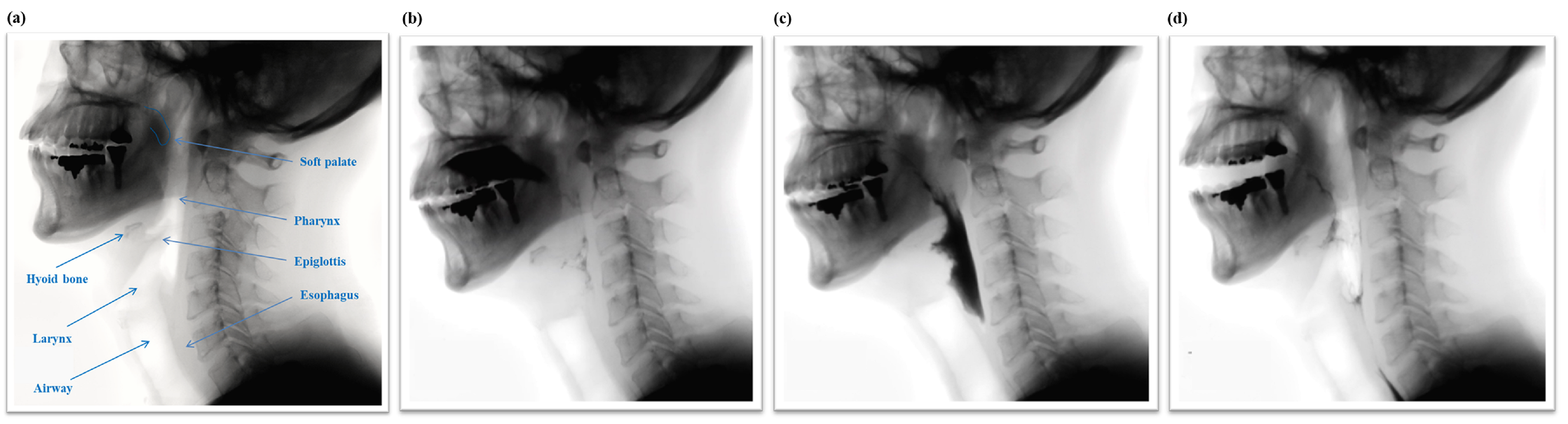 Automatic Detection of the Pharyngeal Phase in Raw Videos for the ...