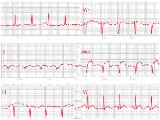 Single-Lead ECG Recordings Including Einthoven and Wilson Leads by a ...