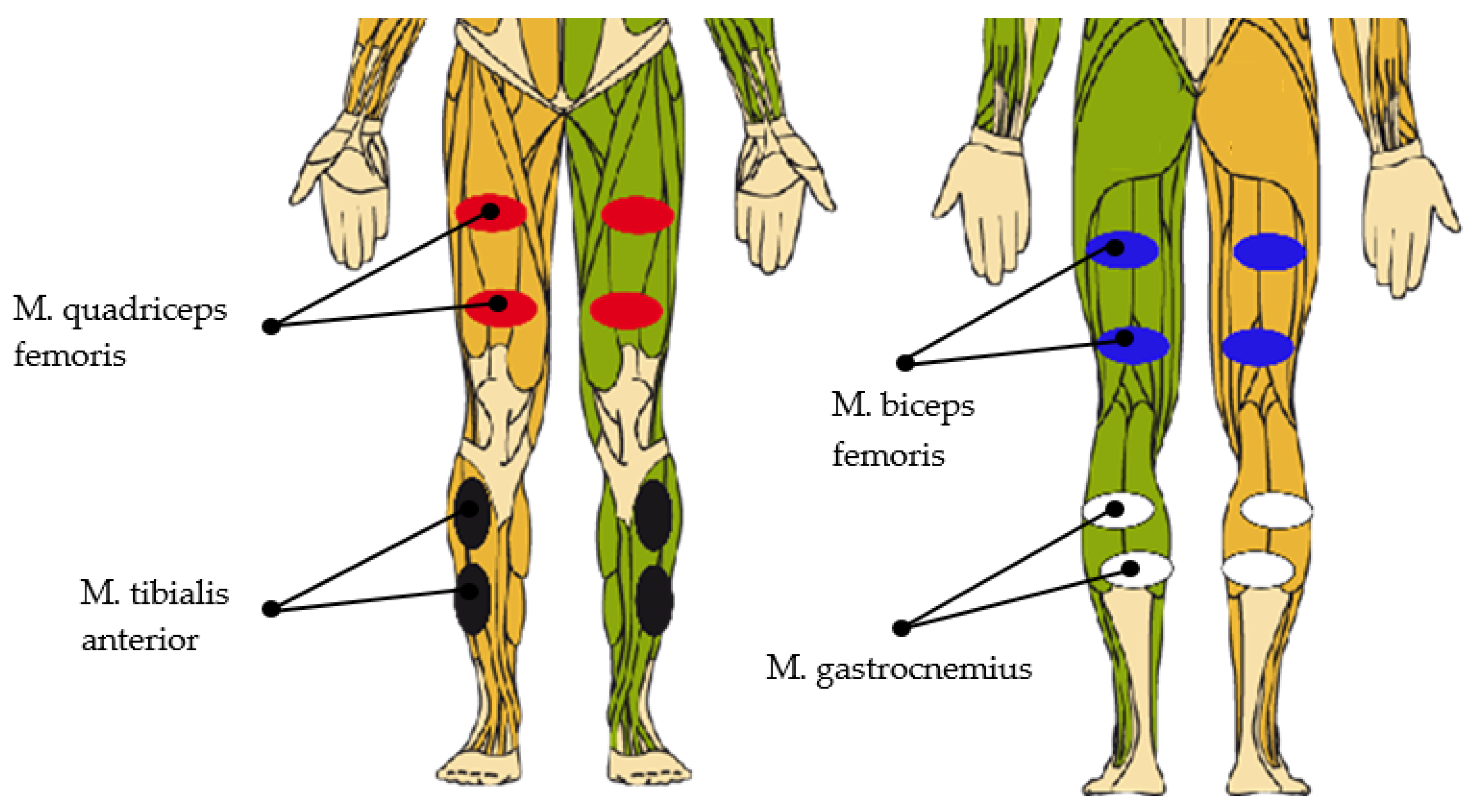 Feasibility Of A Sensor Based Gait Event Detection Algorithm For Triggering Functional