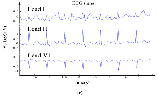 A Low-Power High-Data-Transmission Multi-Lead ECG Acquisition Sensor System