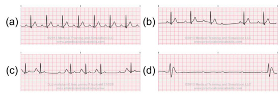 A Survey of Heart Anomaly Detection Using Ambulatory Electrocardiogram ...