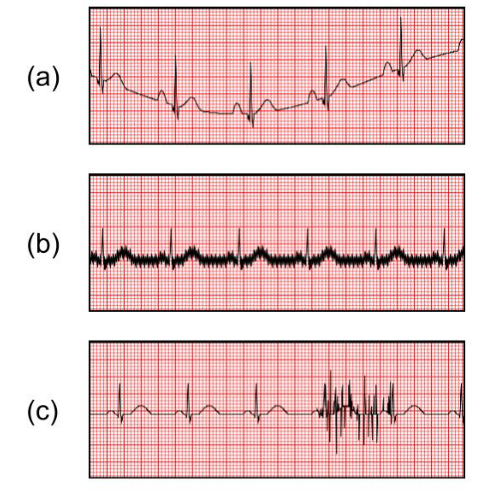 A Survey of Heart Anomaly Detection Using Ambulatory Electrocardiogram ...