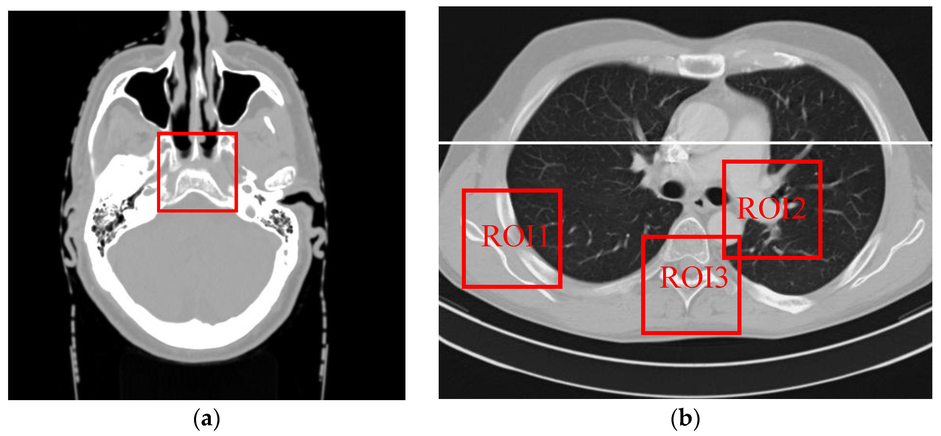Low Dose CT Image Reconstruction Based on Structure Tensor Total Variation Using Accelerated ...