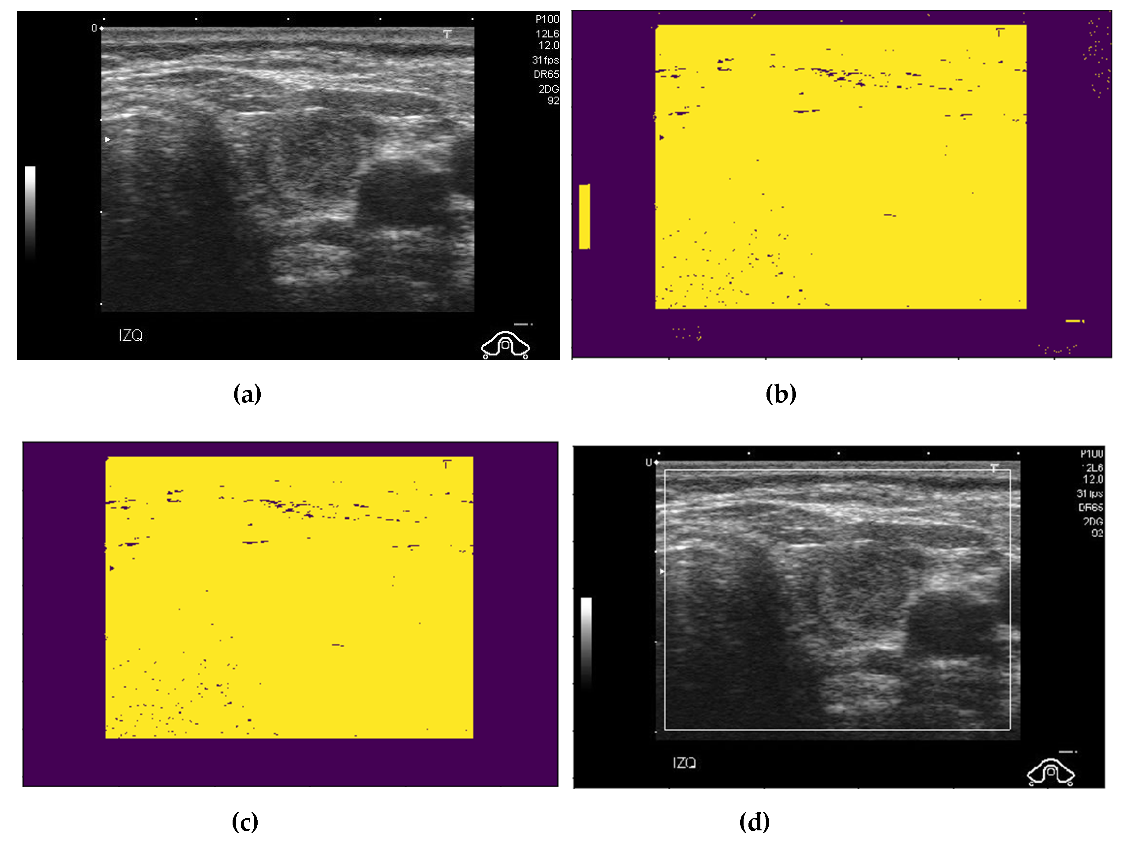 Ultrasound Image-Based Diagnosis of Malignant Thyroid Nodule Using ...