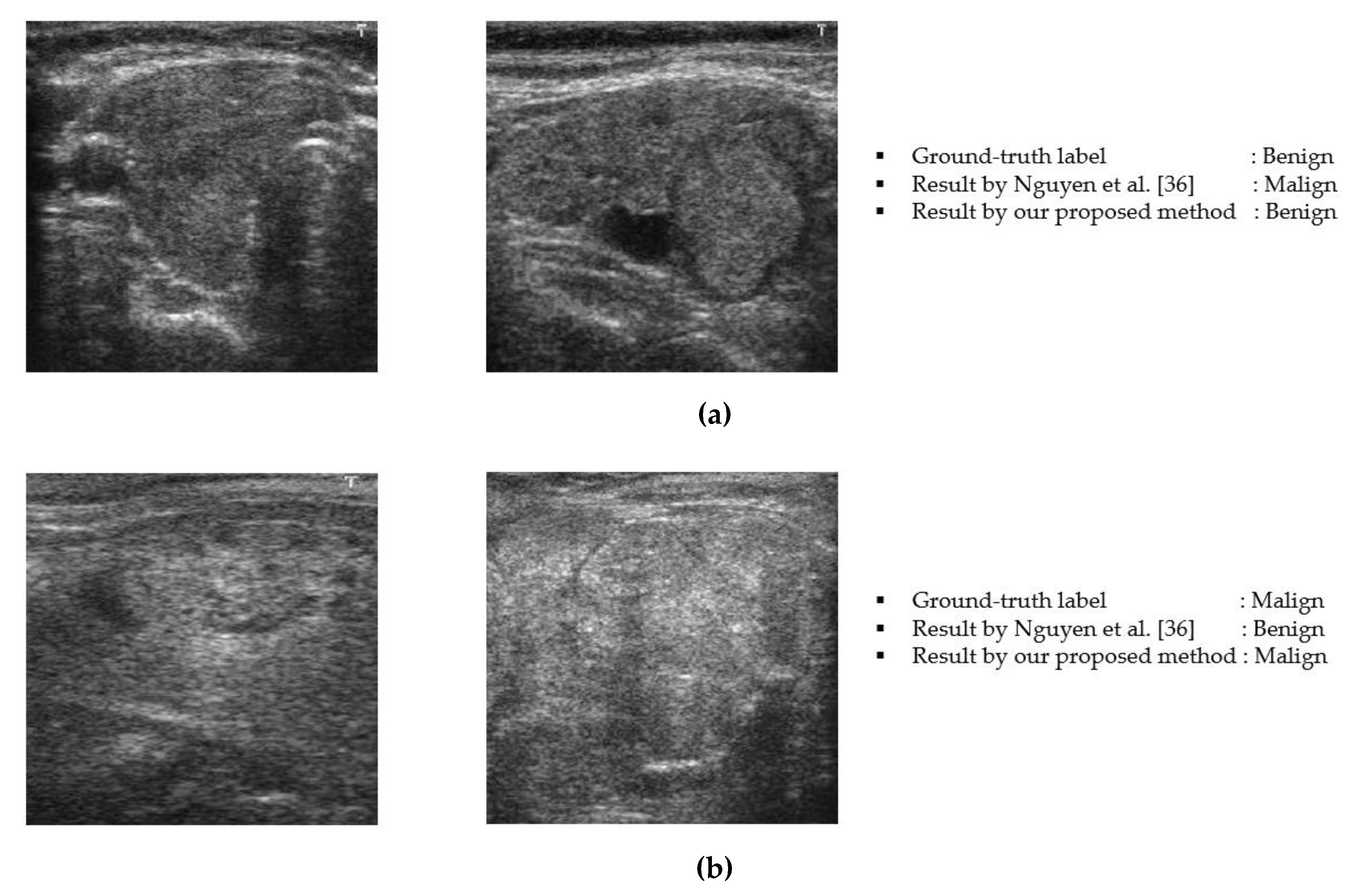Sensors | Free Full-Text | Ultrasound Image-Based Diagnosis of Malignant Thyroid Nodule Using ...