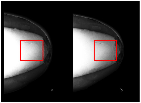 Multimodal Breast Phantoms for Microwave, Ultrasound, Mammography ...