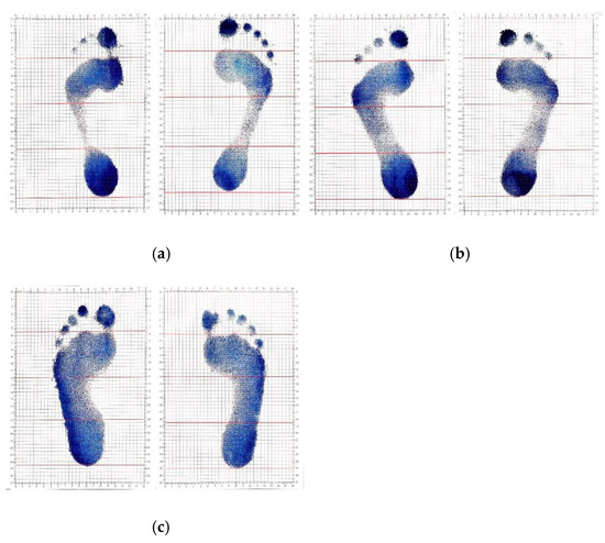 A New Automatic Foot Arch Index Measurement Method Based on a Flexible ...