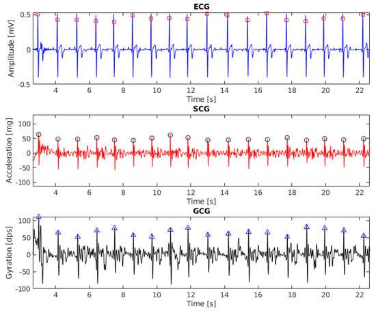Heart Rate Variability Analysis on Electrocardiograms ...