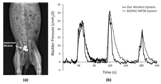 Designing and Implementing an Implantable Wireless Micromanometer ...
