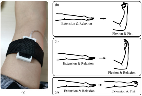 An Ultra-Sensitive Modular Hybrid EMG–FMG Sensor with Floating Electrodes