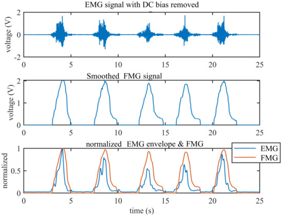 An Ultra-Sensitive Modular Hybrid EMG–FMG Sensor with Floating Electrodes