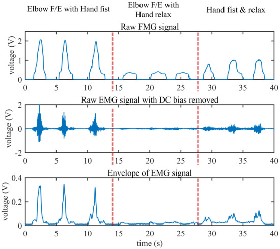 An Ultra-Sensitive Modular Hybrid EMG–FMG Sensor with Floating Electrodes