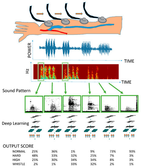Evaluation of Hemodialysis Arteriovenous Bruit by Deep Learning