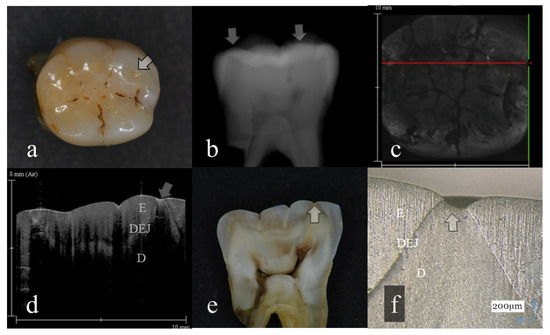 Diagnosis of Occlusal Tooth Wear Using 3D Imaging of Optical Coherence ...