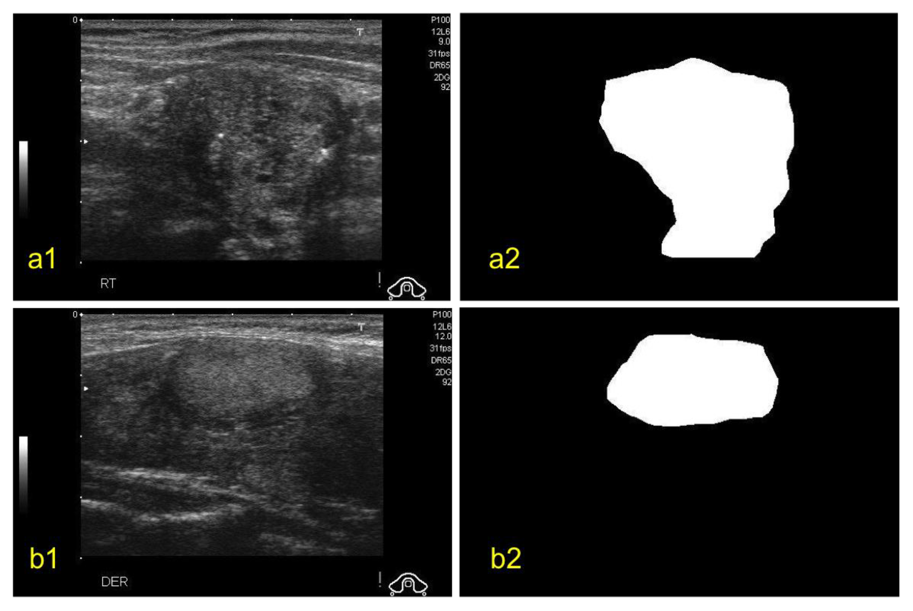 Thyroid Nodule Classification for Physician Decision Support Using Machine Learning-Evaluated ...