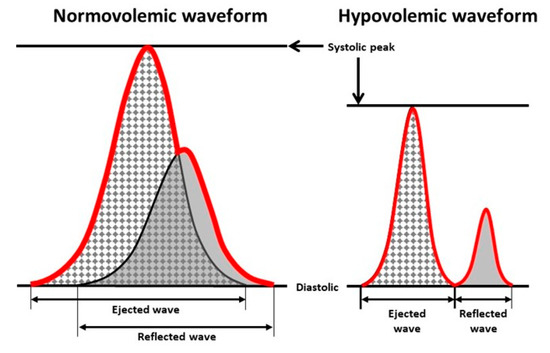 Wearable Sensors Incorporating Compensatory Reserve Measurement for ...