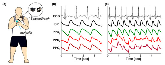 Wearable Sensors Incorporating Compensatory Reserve Measurement for ...
