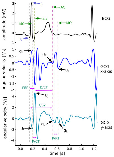 Gyrocardiography: A Review of the Definition, History, Waveform ...