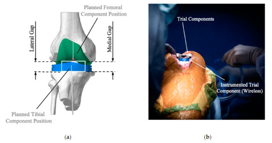 Sensors | Free Full-Text | Achieving a Balanced Knee in Robotic TKA