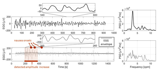 Sensors | Free Full-Text | Electrogastrography in Autonomous Vehicles—An Objective Method for ...