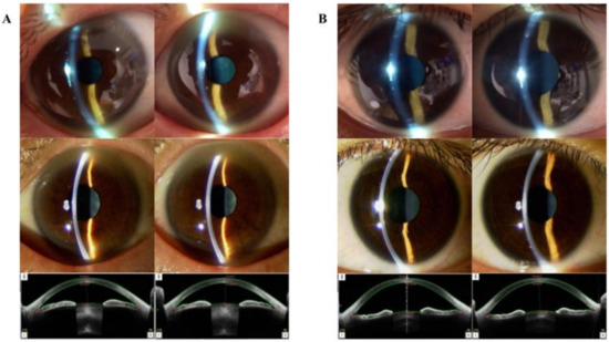A Study Validating the Estimation of Anterior Chamber Depth and ...