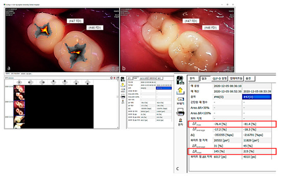 Detection of Dental Caries and Cracks with Quantitative Light-Induced ...