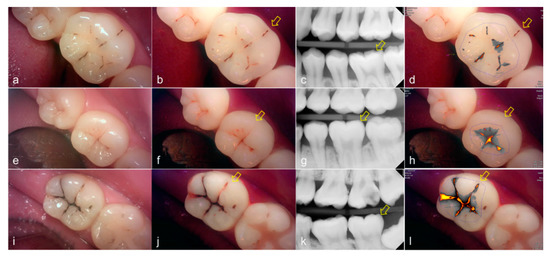 Detection of Dental Caries and Cracks with Quantitative Light-Induced ...