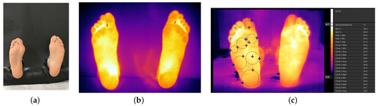 The Use of Infrared Thermography to Develop and Assess a Wearable Sock ...