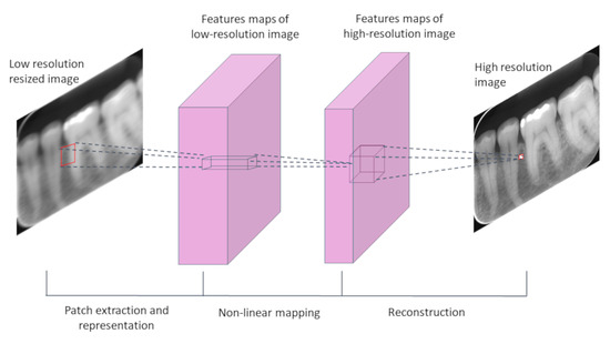 Do Radiographic Assessments of Periodontal Bone Loss Improve with Deep ...