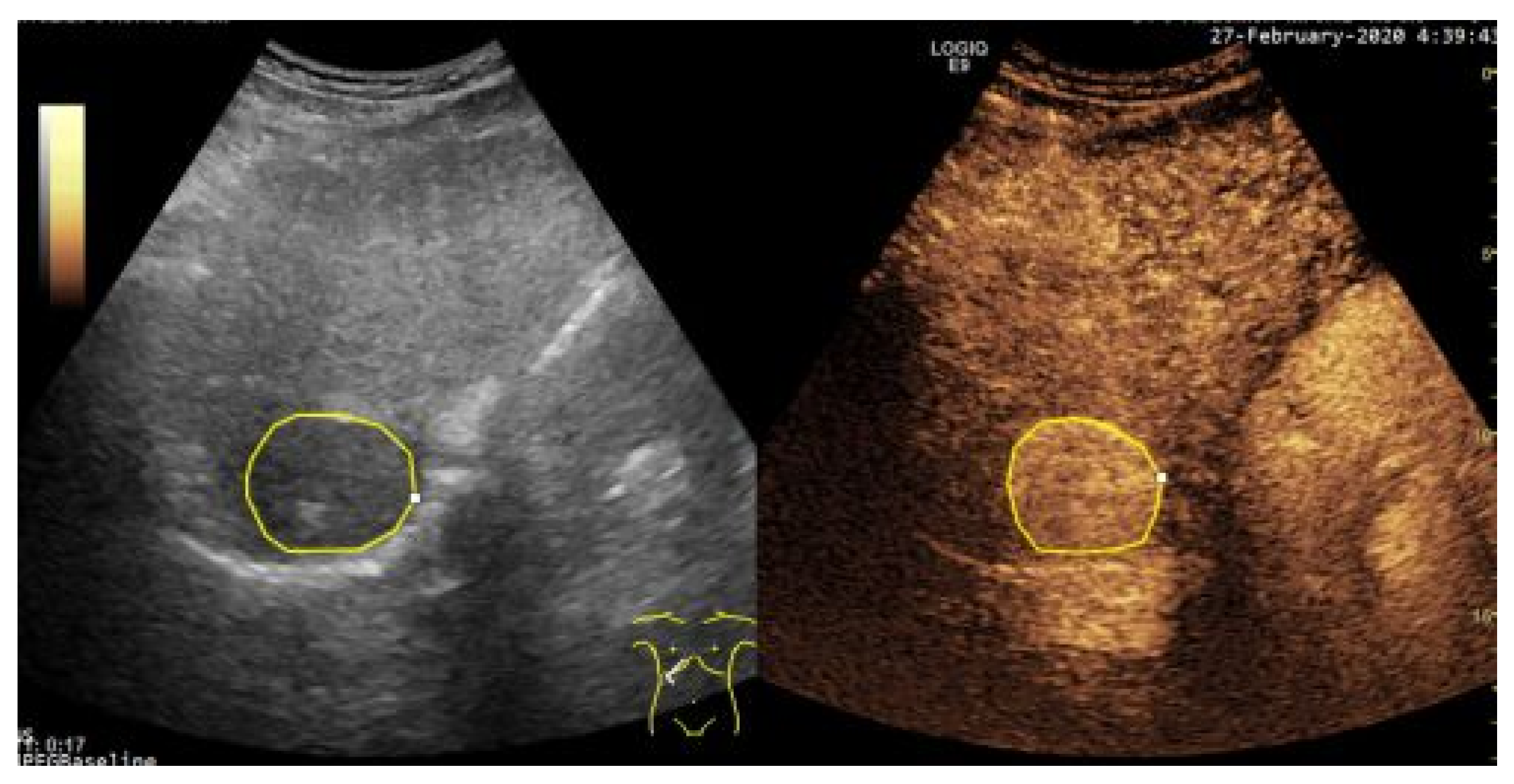 Liver Cancer Ultrasound