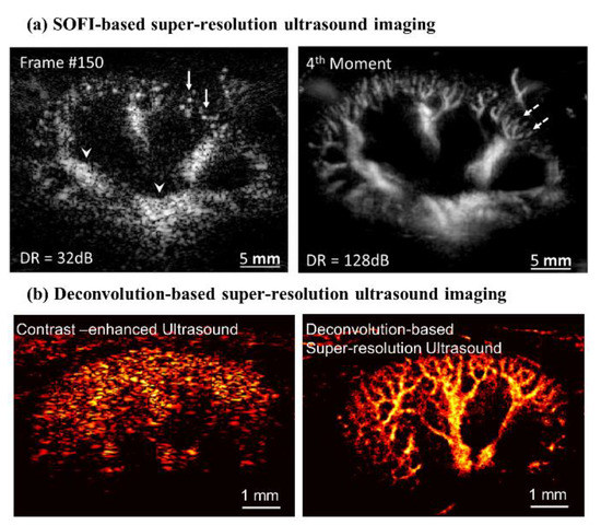 Sensors | Free Full-Text | Current Development and Applications of Super-Resolution Ultrasound ...