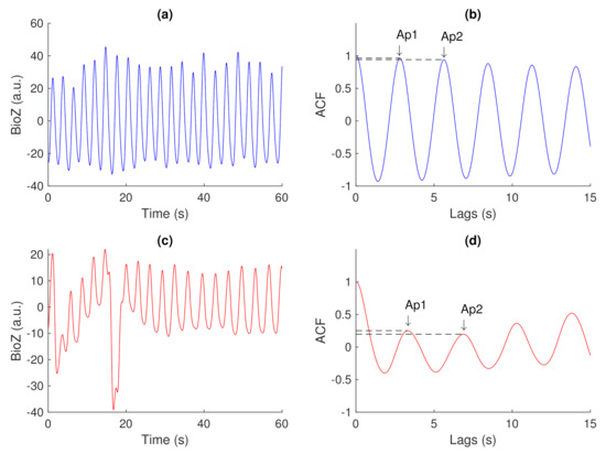 Artefact Detection in Impedance Pneumography Signals: A Machine ...