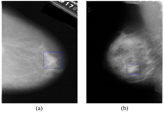 Breast Mass Detection in Mammography Based on Image Template Matching ...