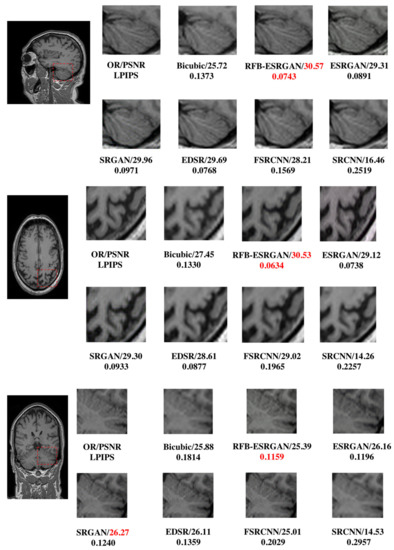 3D MRI Reconstruction Based on 2D Generative Adversarial Network Super ...