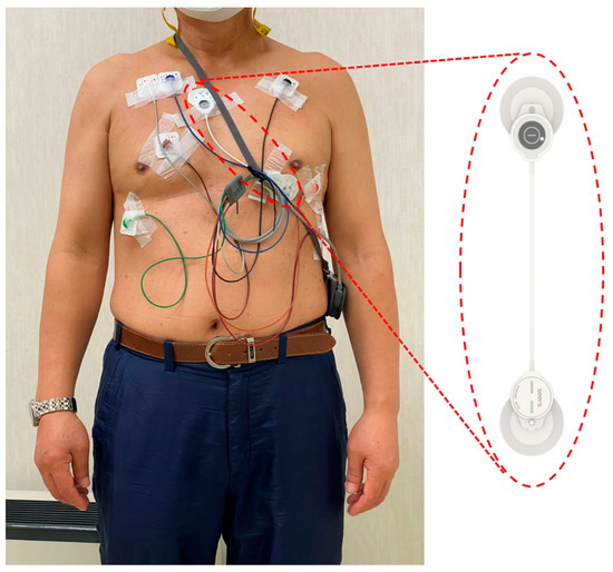 Validation of Adhesive Single-Lead ECG Device Compared with Holter ...
