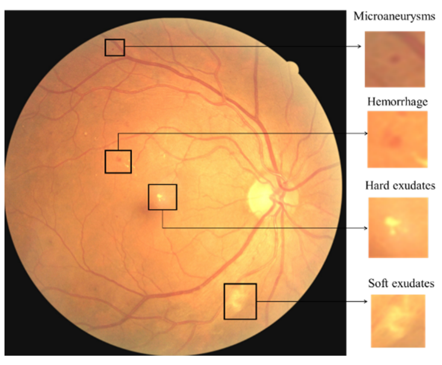 Diabetic Retinopathy Grading System Based On Transfer - vrogue.co Diabetic Retinopathy Grading System Based On Transfer - vrogue.co