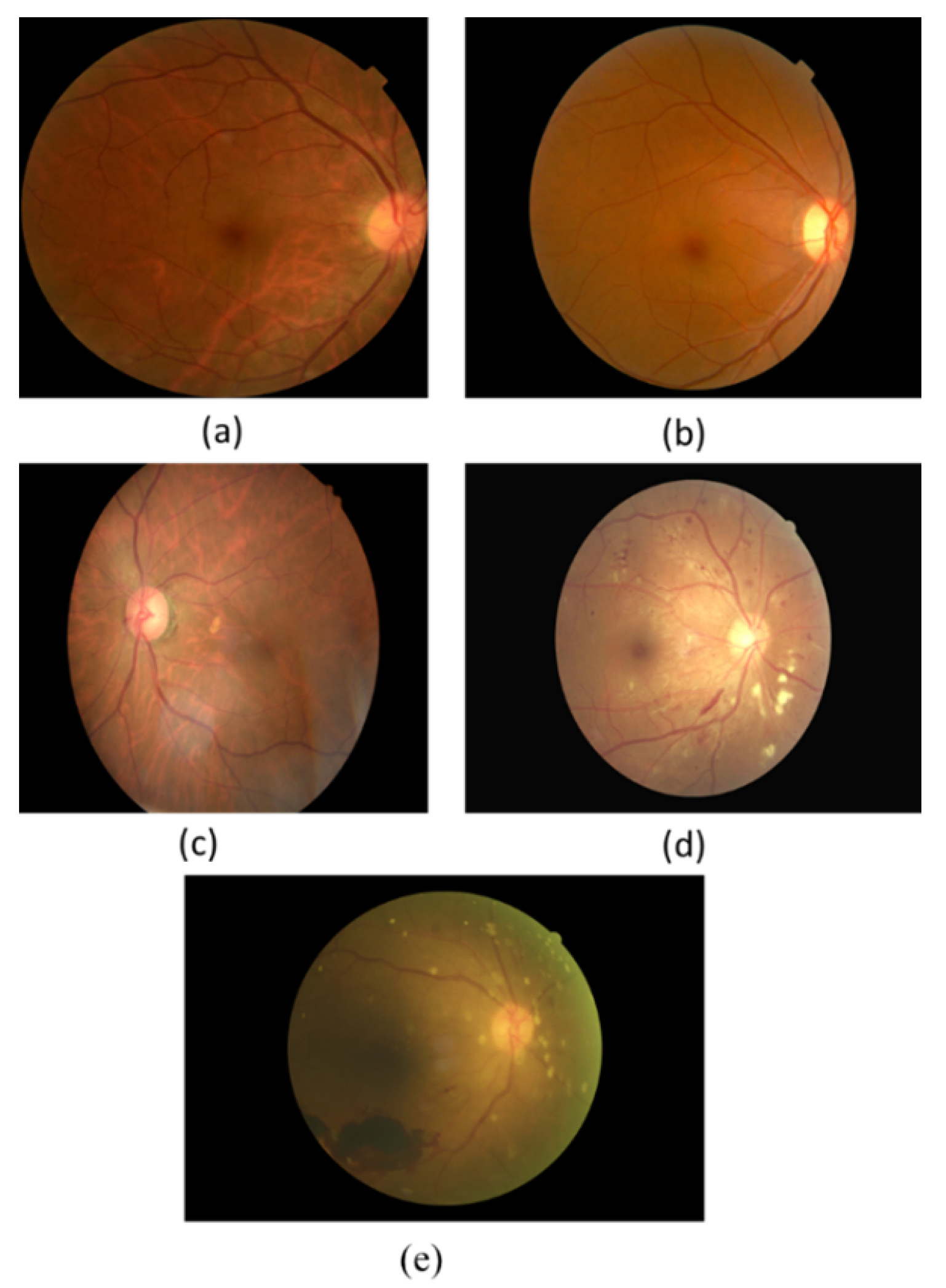 Sensors Free Full Text Diabetic Retinopathy Fundus Image