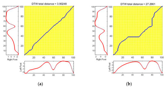Asymmetric Gait Analysis Using a DTW Algorithm with Combined Gyroscope and Pressure Sensor