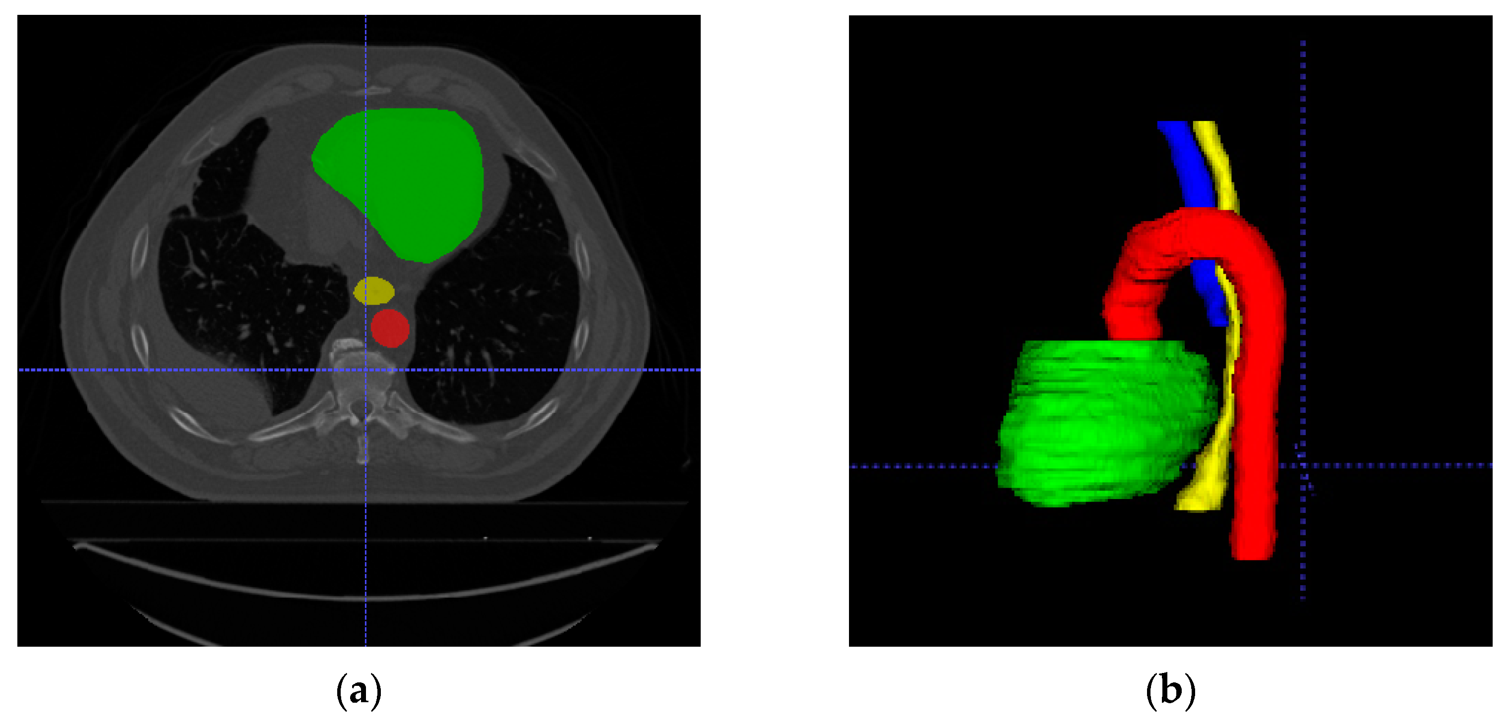Sensors | Free Full-Text | Esophagus Segmentation in CT Images via ...
