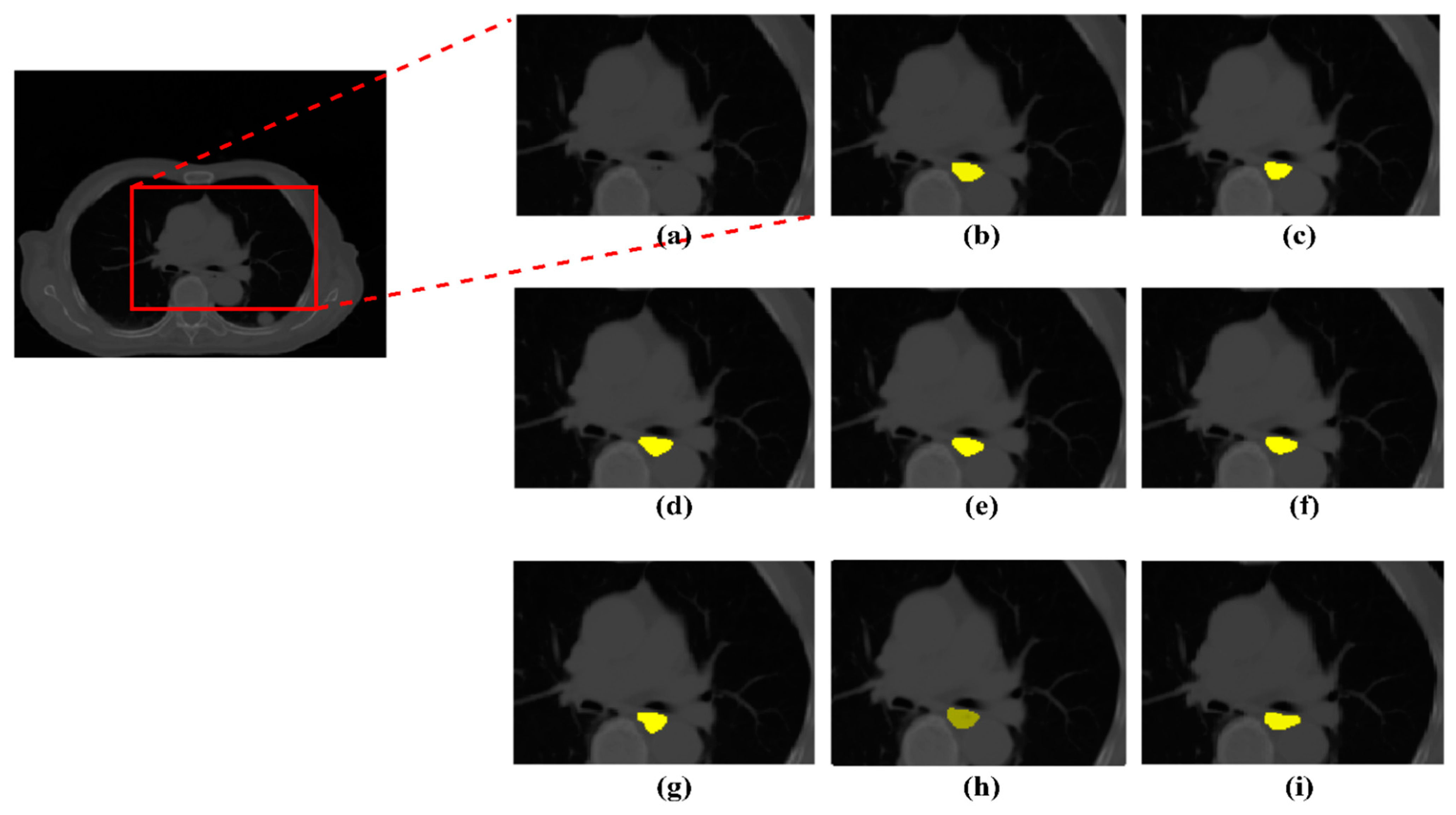 Sensors | Free Full-Text | Esophagus Segmentation in CT Images via ...