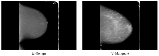 Sensors | Free Full-Text | Computer Vision-Based Microcalcification Detection in Digital ...