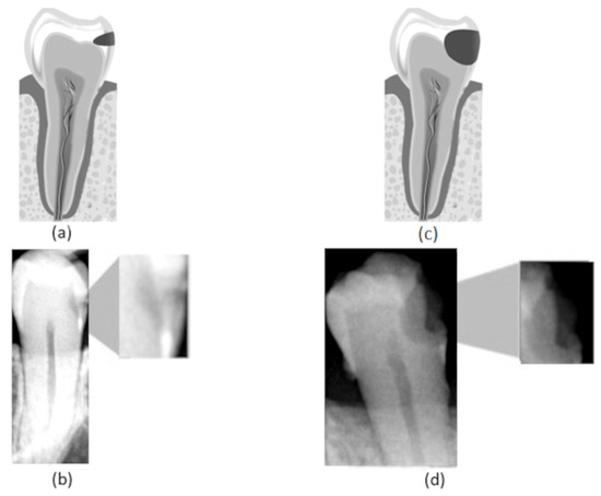 Classification of Approximal Caries in Bitewing Radiographs Using ...