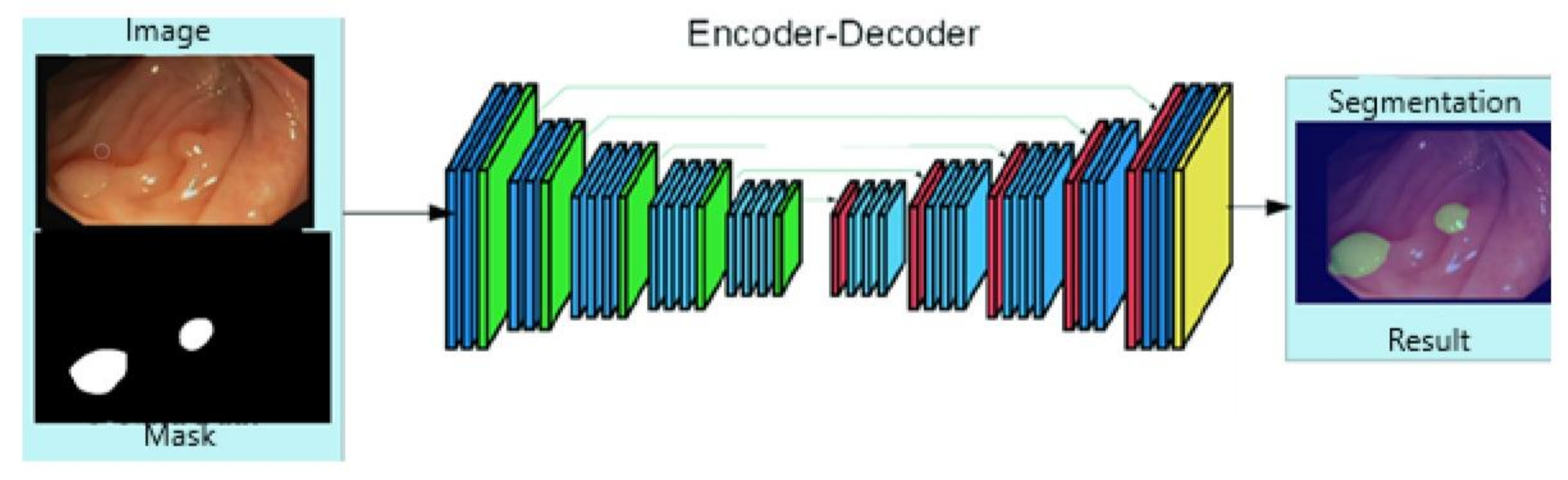Sensors | Free Full-Text | Automatic Detection of Colorectal Polyps Using Transfer Learning
