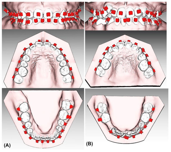 Three-Dimensional Digital Superimposition of Orthodontic Bracket ...