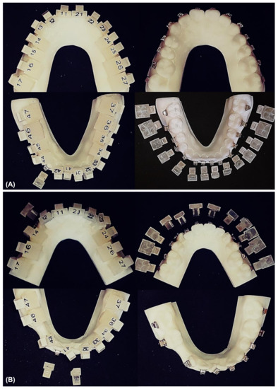 Three-Dimensional Digital Superimposition of Orthodontic Bracket ...